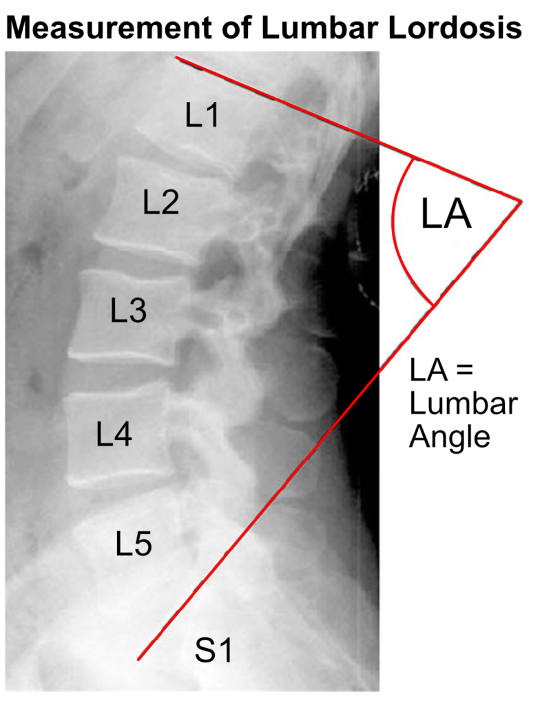Lumbar lordosis or hyperlordosis - Back Care Clinic