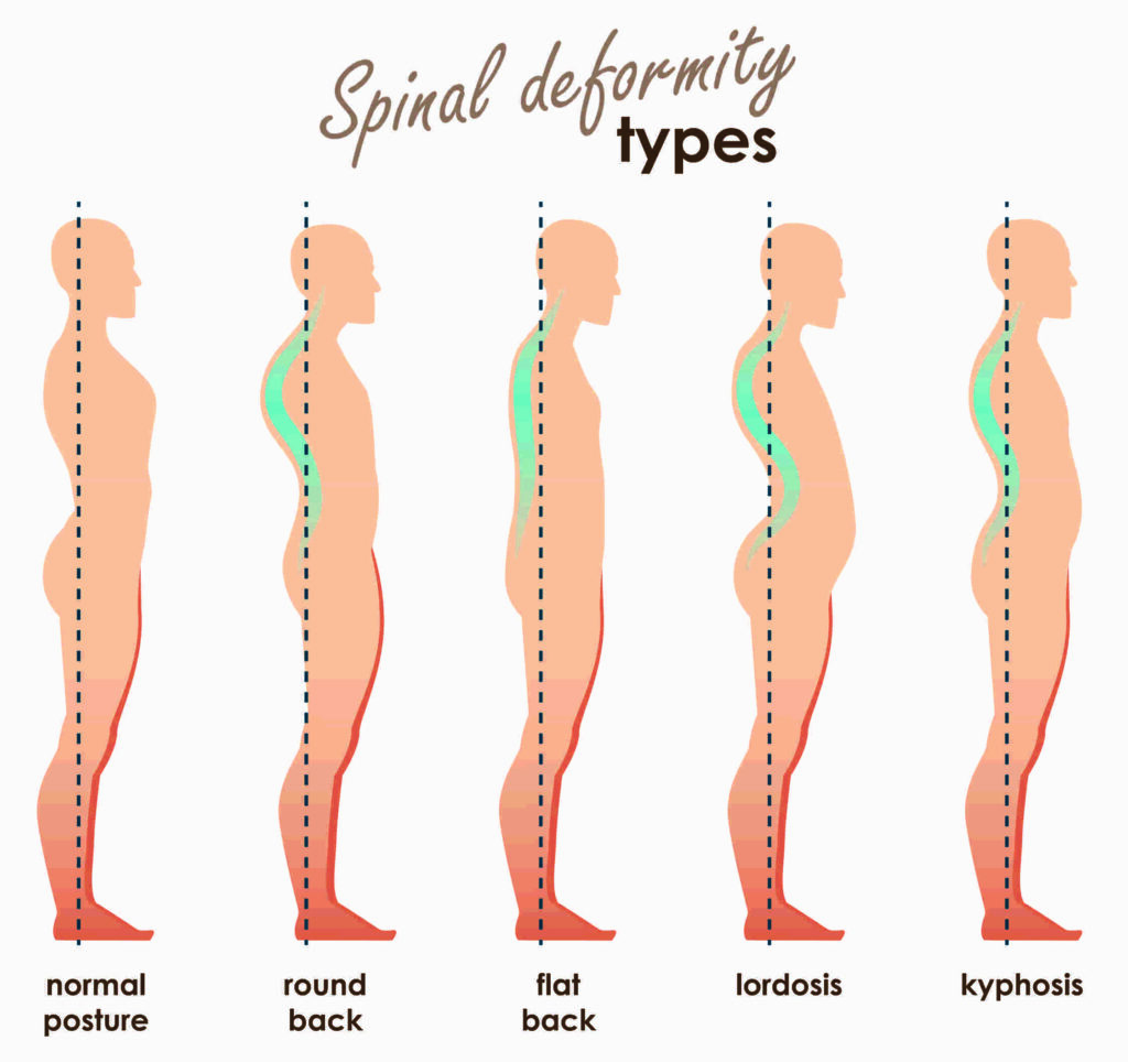 Lumbar lordosis or hyperlordosis - Back Care Clinic