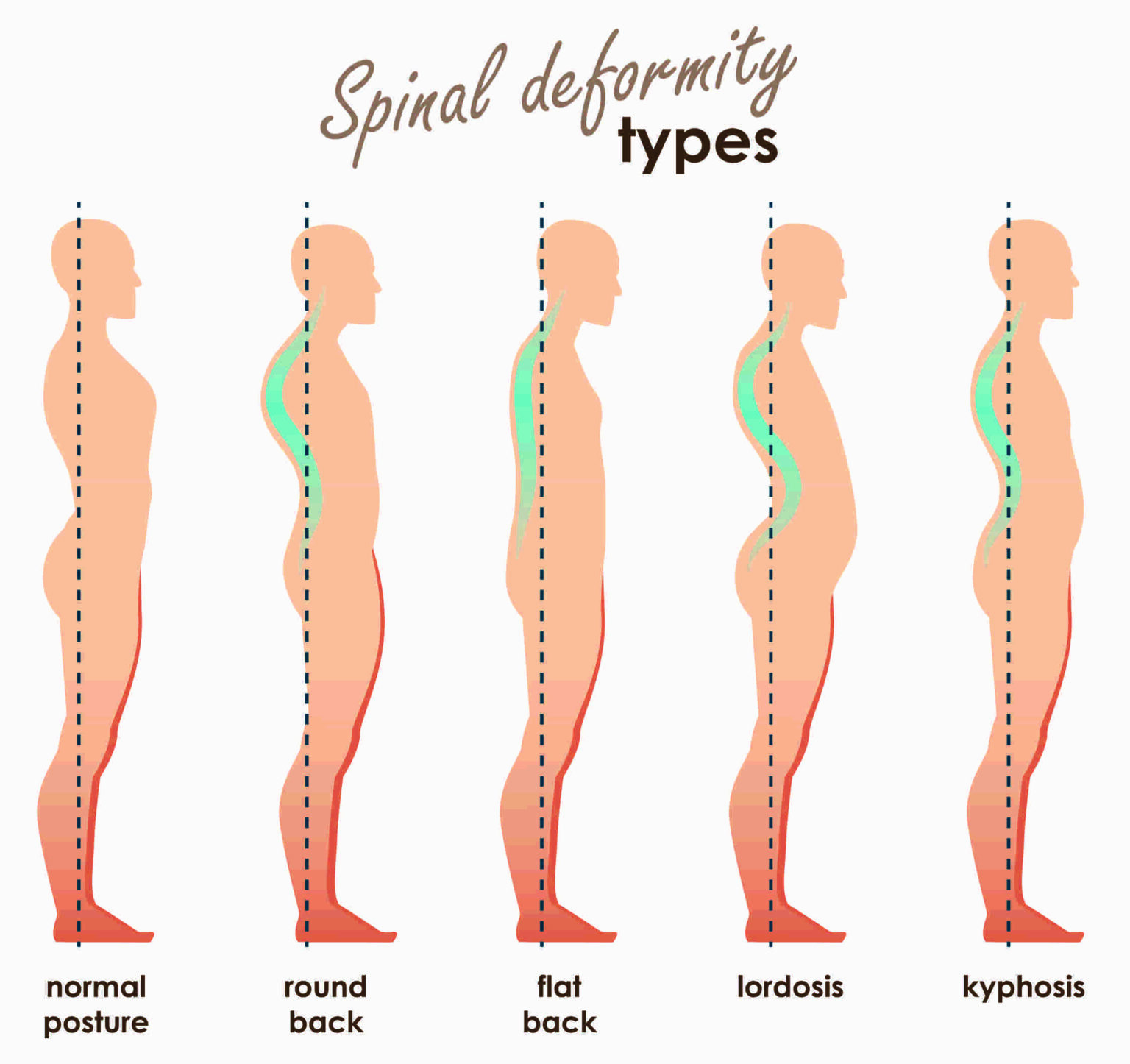 Lumbar lordosis or hyperlordosis - Back Care Clinic