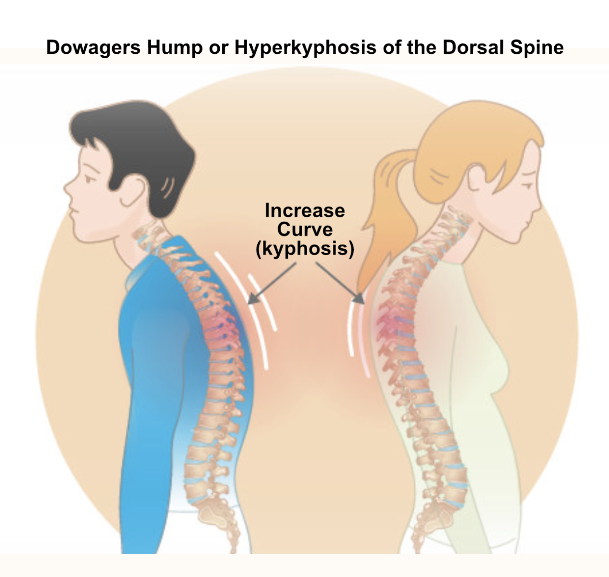 Dowager's Hump - Back Care Clinic