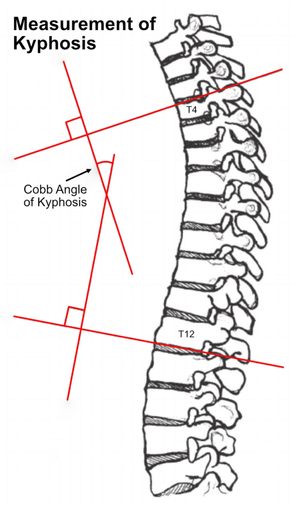 Dowager's Hump - Back Care Clinic