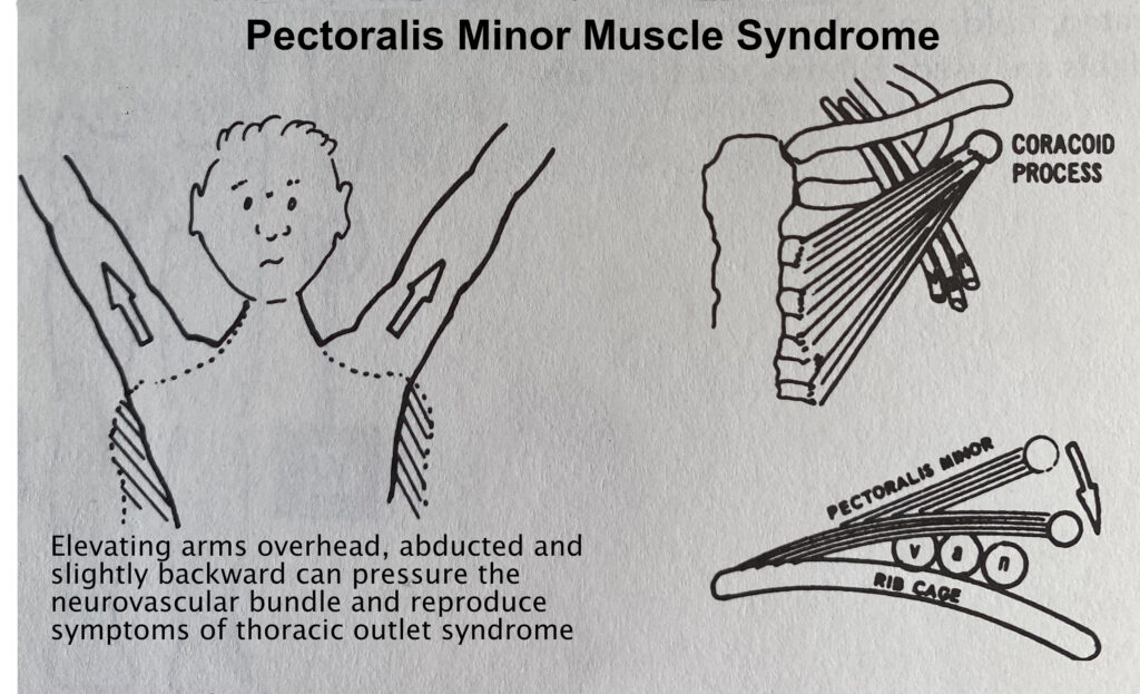 Thoracic Outlet Syndrome (TOS) and other similar conditions - Back Care ...