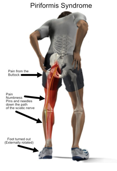 Piriformis Syndrome - Back Care Clinic