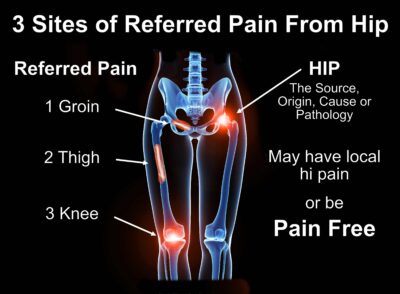 Referred Pain - Back Care Clinic