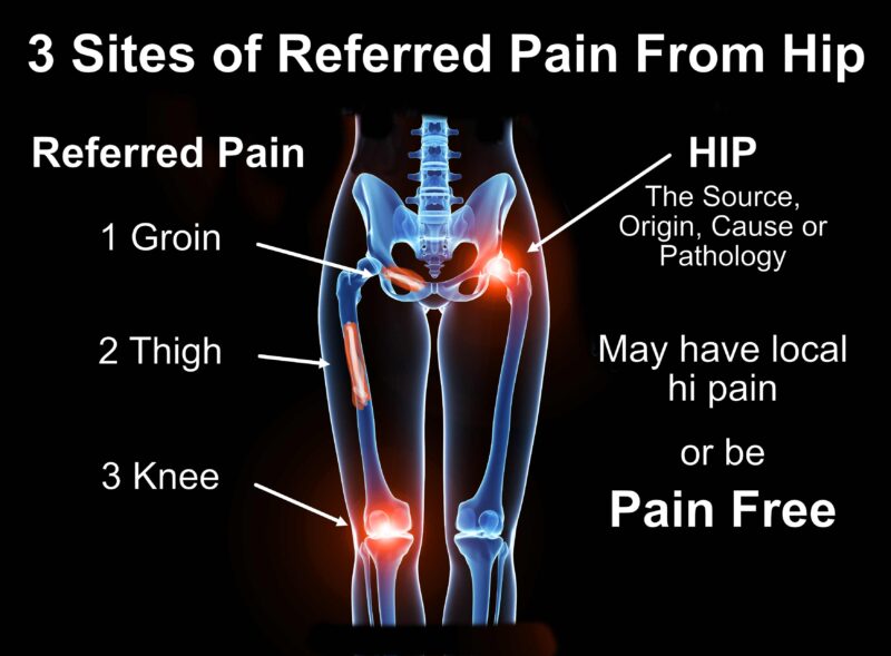 Referred Pain - Back Care Clinic