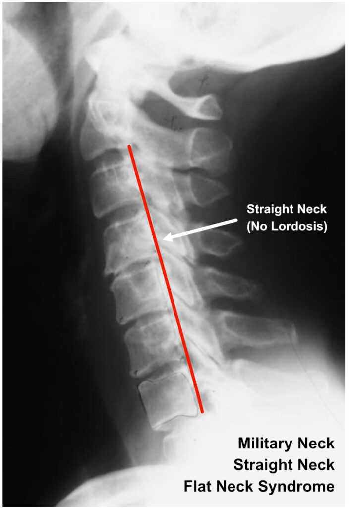 Neck Curve Misalignments - Back Care Clinic