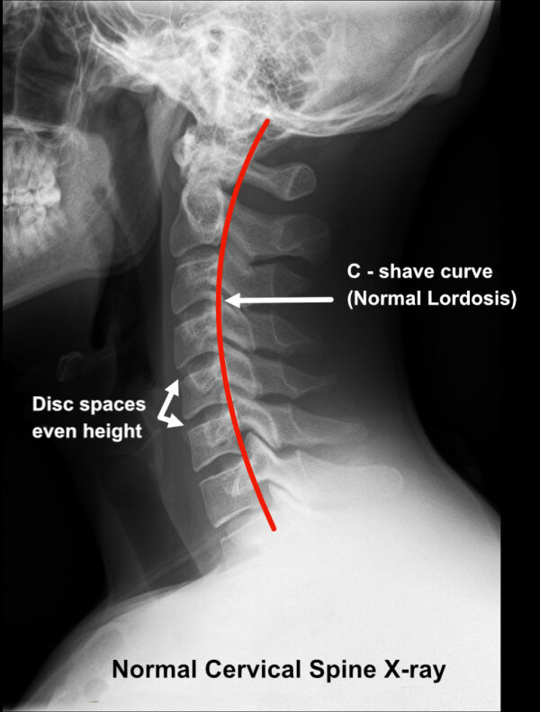 Neck Curve Misalignments - Back Care Clinic