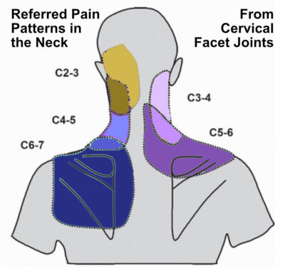 Referred Pain - Back Care Clinic