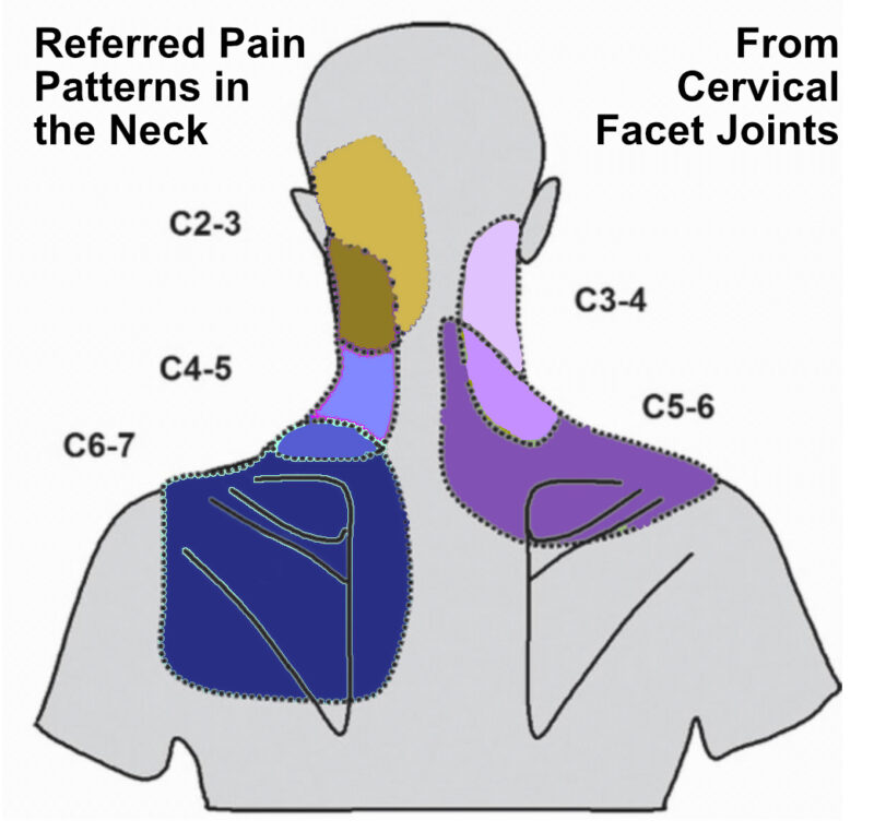 Referred Pain - Back Care Clinic