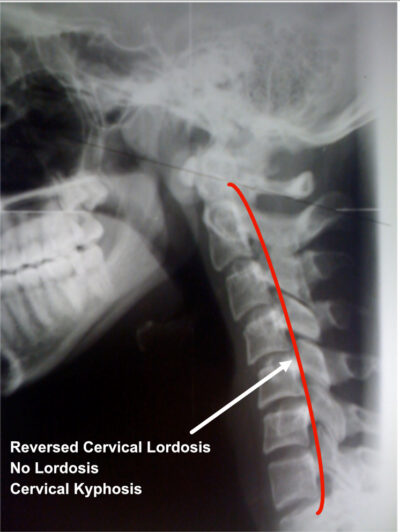 Neck Curve Misalignments - Back Care Clinic