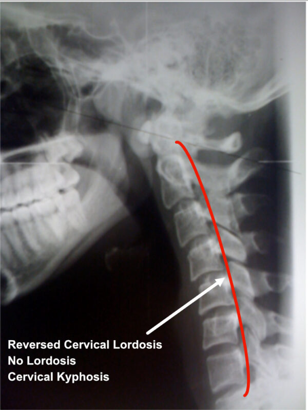 Neck Curve Misalignments - Back Care Clinic