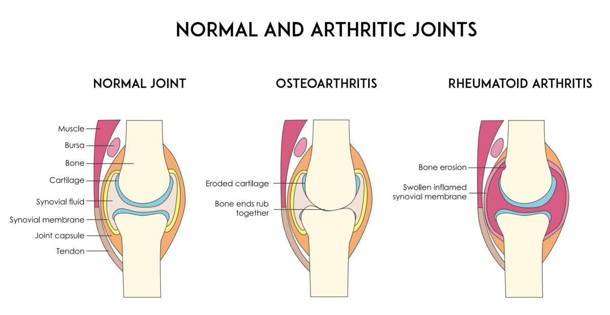 Chiropractic treatment for Arthritis - Back Care Clinic